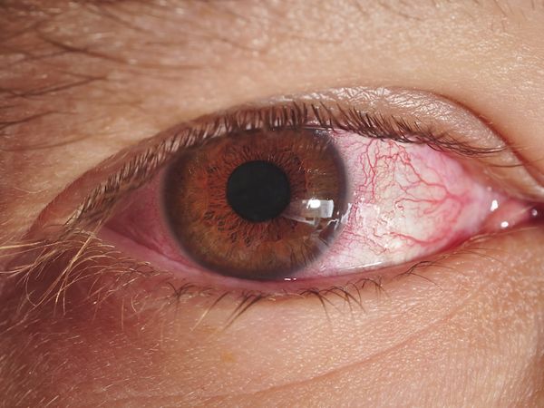 Why Does Cannabis Make Your Eyes Red? | Leafist